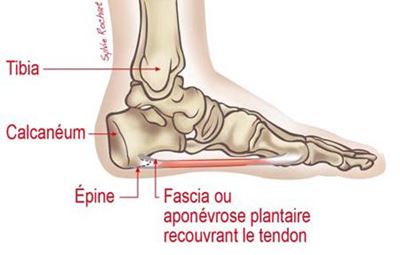 Douleur du talon : Épine calcanéenne et Aponévrosite plantaire